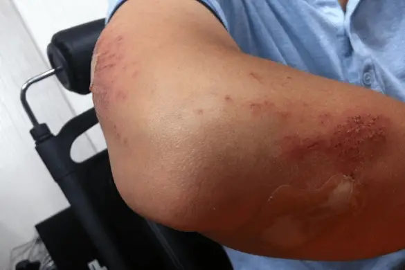 How To Cover Up & Hide Raised Moles (With or Without Makeup)